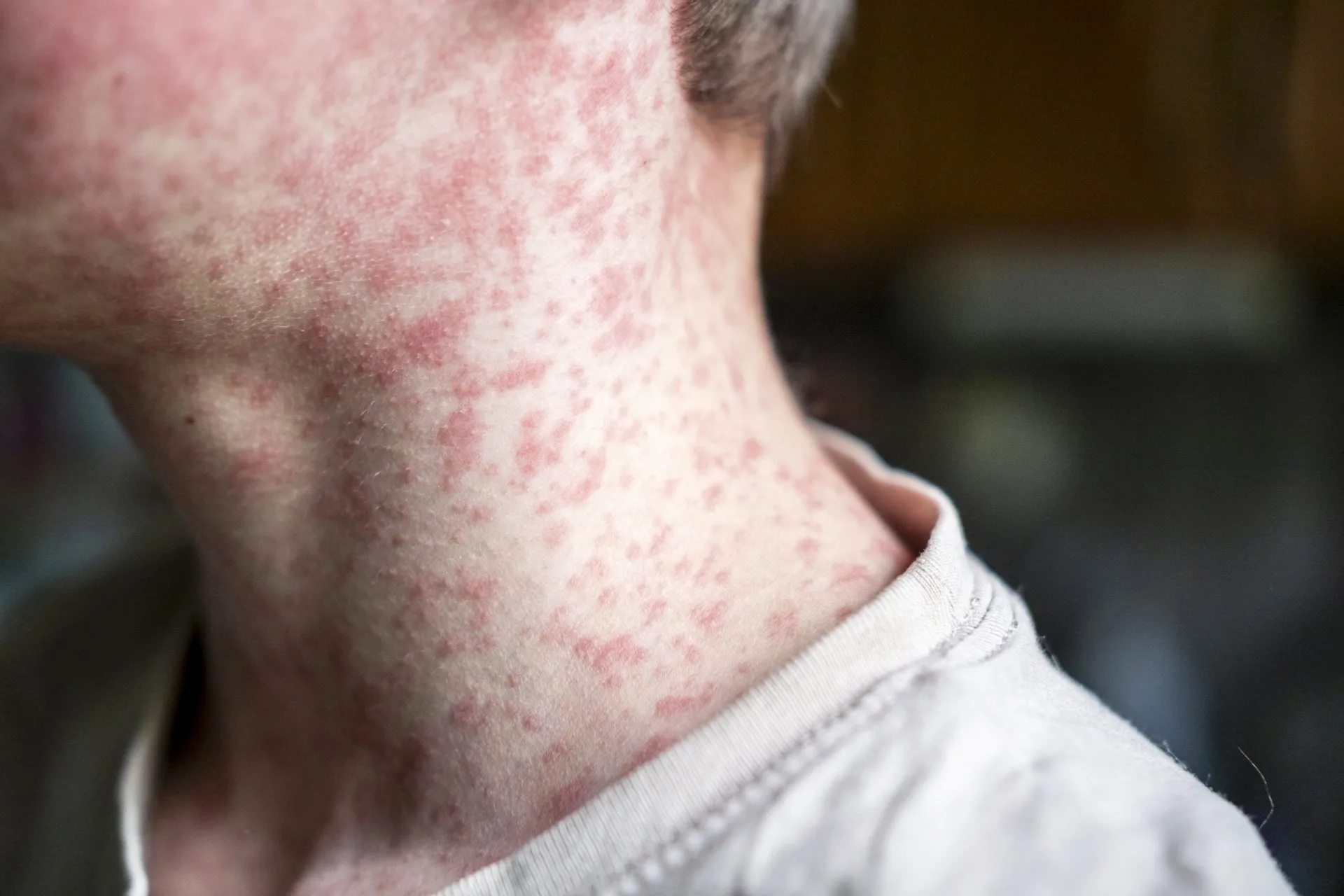 Measles and You – It Takes a Village | ASEBP Wellness